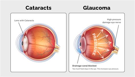 Glaucoma Vs Cataracts Whats The Difference Chelvin Sng Eye Center