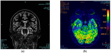Panic Attack Brain Scan