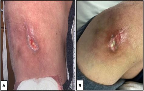Distinguishing Dystrophic Calcification From Calciphylaxis Pmc