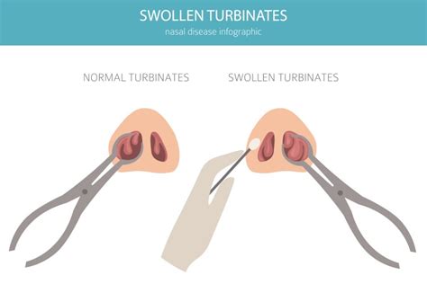 Swollen Turbinates Nasal Diseases Medical Vector Image