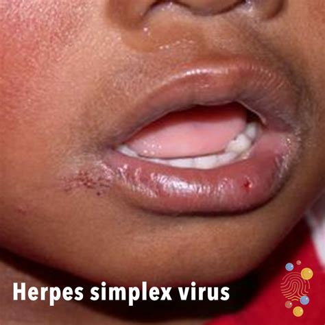 Lips Herpes Simplex Cure At Alicia Hooks Blog