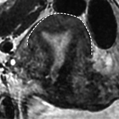 Mri Of Pregnancy Related Issues Mllerian Duct Anomalies Ajr