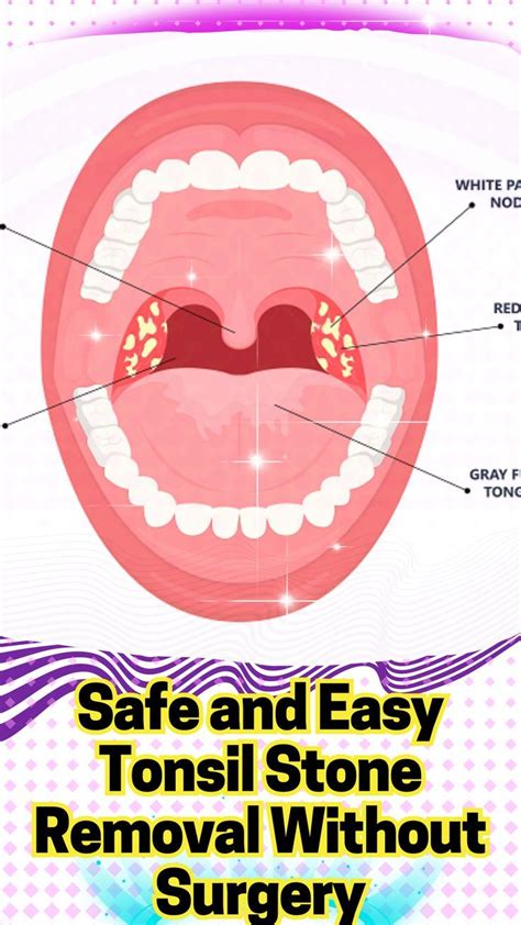 What Are Tonsil Stones How To Safely Remove Them Artofit
