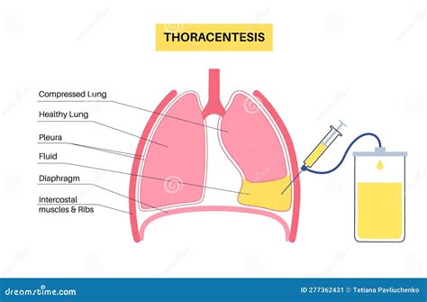 Thoracentesis Medical Procedure Cartoon Vector