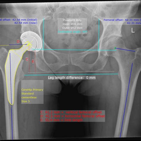 Radiological Outcome After Hip Replacement With Superpath Approach Download Scientific Diagram