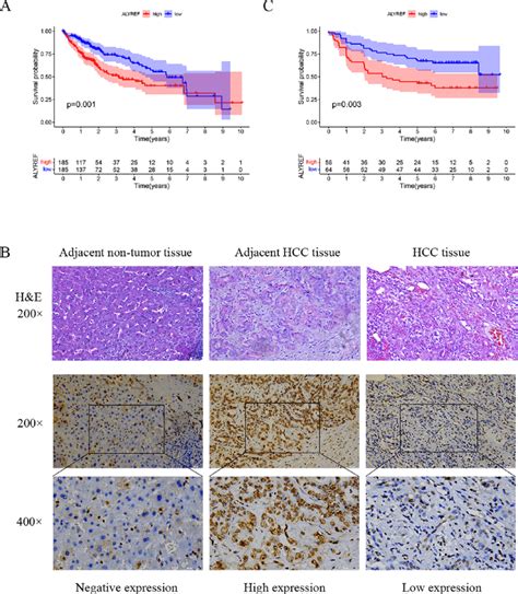 Alyref Expression Is Upregulated In Hcc And Is Associated With Poor