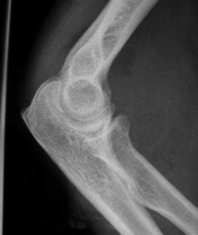 How To Read An Elbow X Ray Emergency Medicine Education Newyork