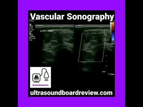 Popliteal Compartment Syndrome Ultrasound Youtube