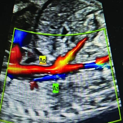 The Azygous Vein Is Positioned Parallel To And Behind The Descending