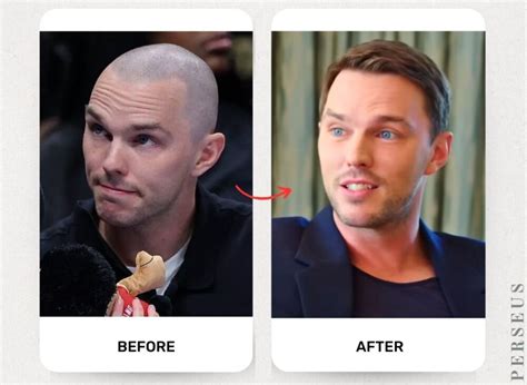 Celebs With Hair Loss How Do They Cope Perseus Hair Care