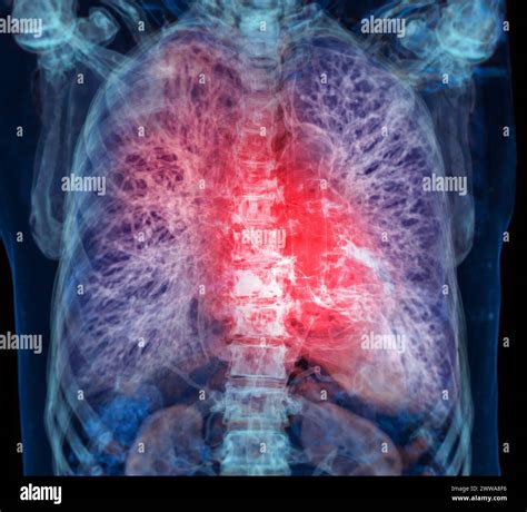 Ct Chest Or Lung 3d Rendering Image Showing Trachea And Lung In