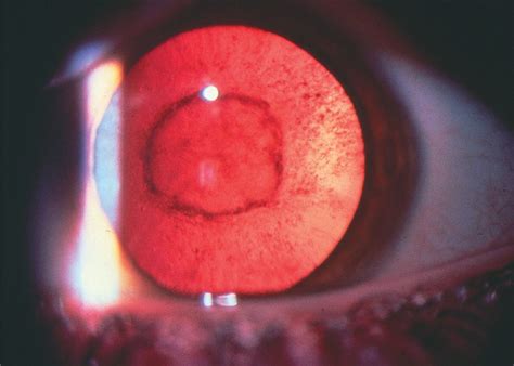 Red Reflex Cataract