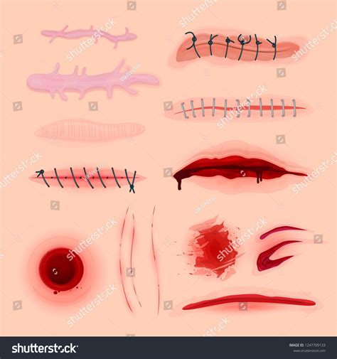 Surgery Scar เวกเตอร์และเวกเตอร์อาร์ตปลอดค่าลิขสิทธิ์และรับสิทธิ์ใช้