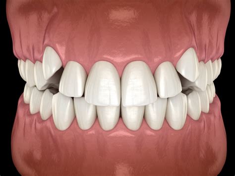 Crowded Teeth Common Problems Cranbourne North Dental