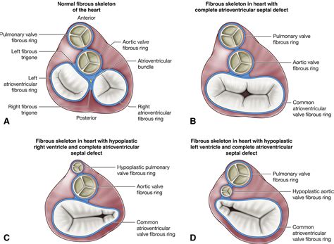 Atrioventricular Valve Surgery Restoration Of The Fibrous Skeleton Of