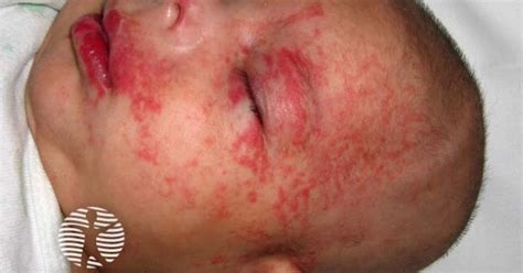 Phaces — Segmental Facial Haemangioma Image