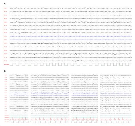 A Typical Interictal Electroencephalographic Background Activity In