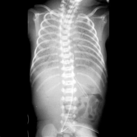 Endotracheal Tube Placement In Neonates X Ray