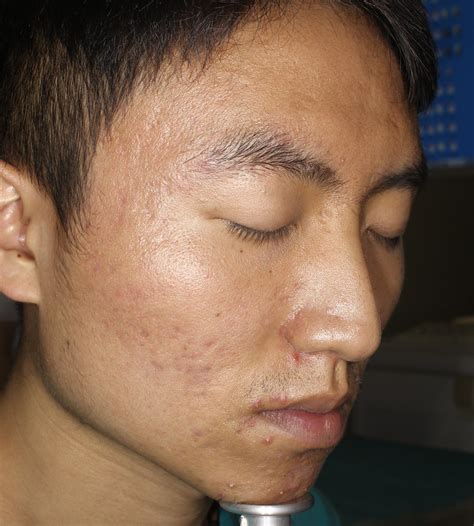 Acne Object Detection Dataset By Kritsakorn