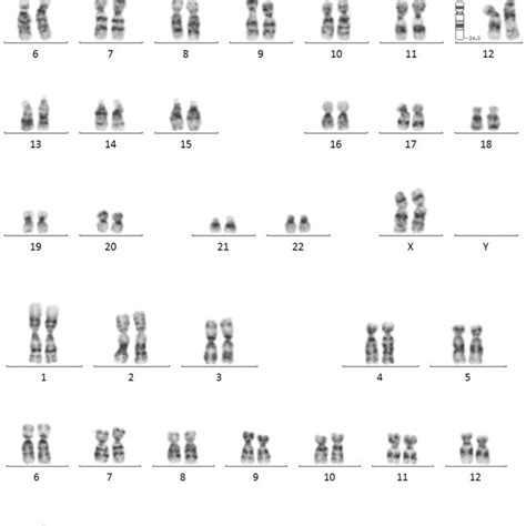 Result Of The Affymetrix Cytoscan 750 Snp Array In Patient 15 In The