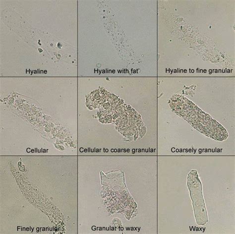 Medical Laboratory And Biomedical Science Urinary Casts