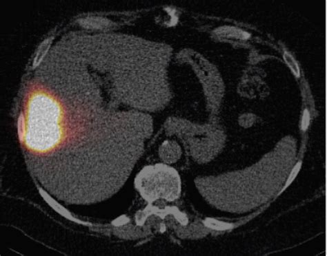 Radiation Segmentectomy And Subsegmentectomy Of Hepatocellular Carcinoma