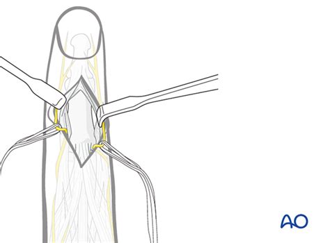 Dorsal Approach To The Middle Phalanx