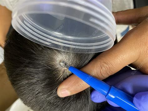 Sampling Ringworm Of The Scalp Stock Image C Science Photo Library