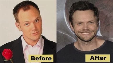 Trasplante De Cabello Bradley Cooper