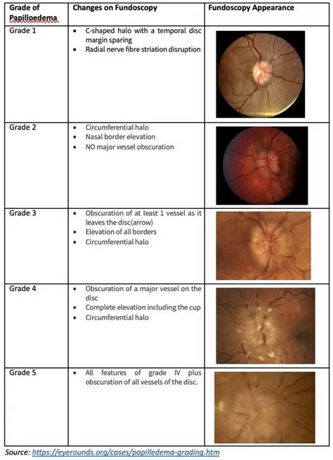 Normal Fundus Vs Disc Edema