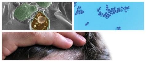 Malassezia Globosa Causes Symptoms And Treatment