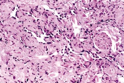Figure 1 Low Grade Angiosarcoma