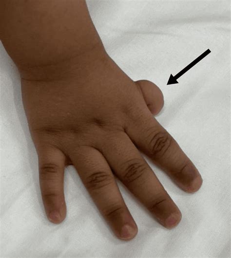 Gray Platelet Syndrome In A Neonate With Vacterl Association A Novel