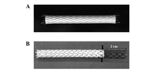 A Fluency Fully Covered Stent With Fully Covered Structure And 2 Mm Download Scientific
