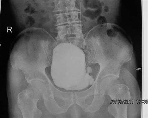 Bladder Diverticulum