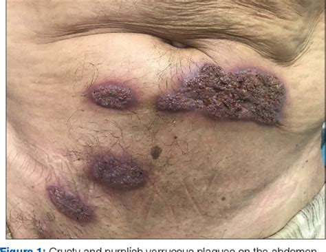 Figure 1 From Multiple Vegetative Lesions Revealing Superficial