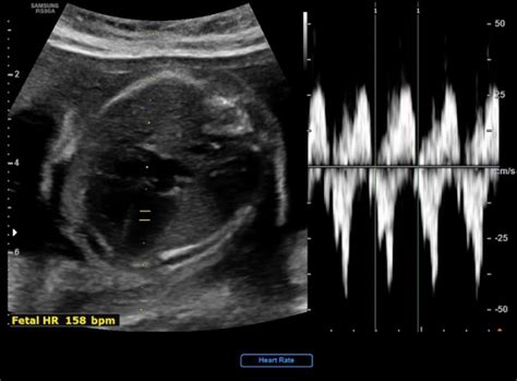 임산부 필수 의사 엄마의 태아 정밀 초음파 용어영어 약자 정리 초음파 보러가기 전 함께 공부해요 네이버 블로그