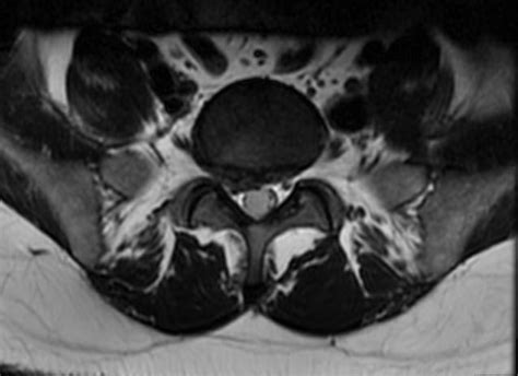 Herniated Disc L5 S1 Rbackpain