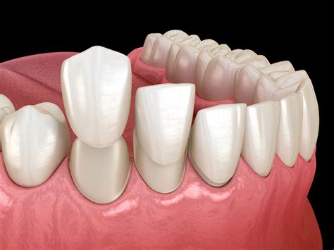 How To Replace Missing Teeth Dental Implant And Aesthetic Specialists