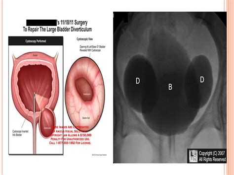 Bladder Diverticulum Cystoscopy