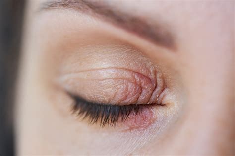 Say Goodbye To Itchy Irritated Eyes A Guide To Managing Blepharitis