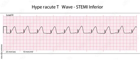 Ecg Hyperacute Stemi 8 Second Ecg Paper Peaked T Wave Vectors And
