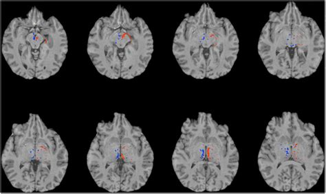 Laterality And Sex Differences Of Human Lateral Habenula Afferent And