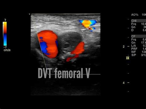 Dvt Or Deep Vein Thrombosis Affecting Femoral And Popliteal Veins