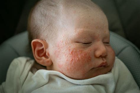 Eccema En Bebés O Dermatitis Atópica Causas Y Tratamiento