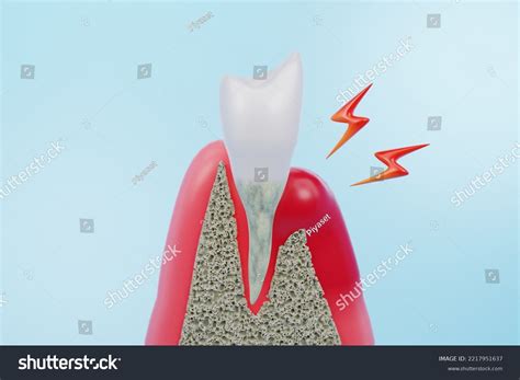 Gum Inflammation Disease Gingivitis Dental Gum Stock Illustration