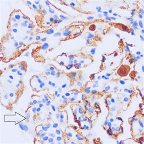 C4d Ihc Staining Pattern Among Mcdfsgs Cases Download Scientific Diagram