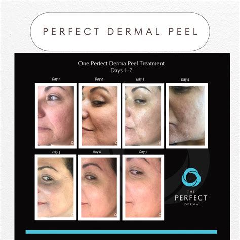 Perfect Dermal Peel Skin Refinement Aspire Care Clinic Chemical