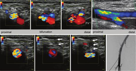 Femoral Artery Ultrasound Cpt Code