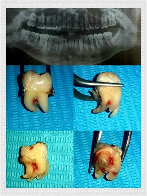 The Dental Hub Wisdom Tooth With Curved Roots Facebook